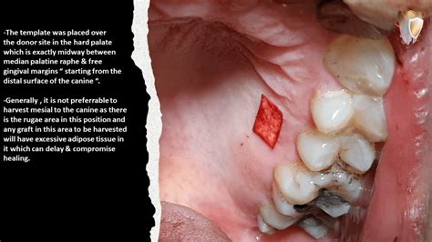 Management Of Single Miller Class I Gingival Recession Through
