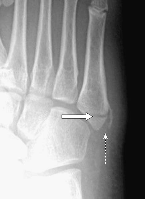 What Is Tuberosity Of The 5th Metatarsal