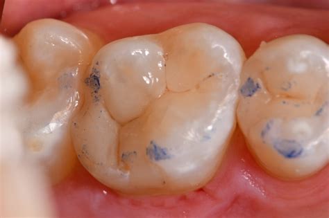 Shallow Simple Class I