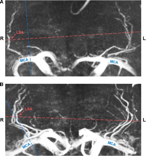 Hypertension Correlates With Stronger Blood Flow Pulsatility In Small