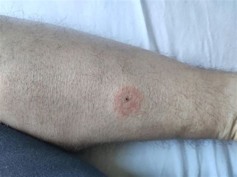 Bug Bite Itchy Rash After 2 Weeks Uk Rmedical