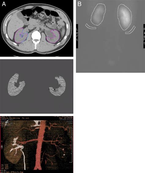 Figure 1 From Differential Renal Function Estimation Using Computerized
