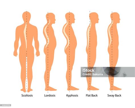 Medical Illustration Of Spinal Deformity Types Scoliosis Lordosis And
