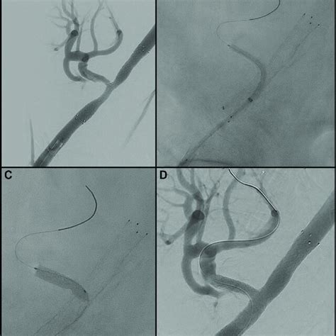 Stenting Procedure A Angiogram Showing Right External Iliac Artery