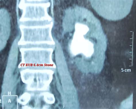 Left Mini Pcnl 1 64cm 2 Single Tract 16fr 3 Pneumatic Lithoclast 4 60 Minutes 5 Complete