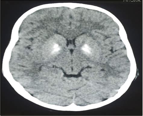 Intracranial Calcification In Down Syndrome Journal Of Pediatric