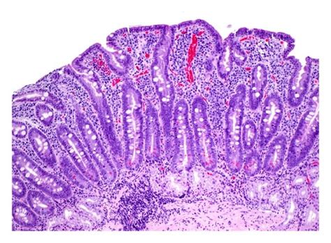 A Biopsy Of The Duodenum Reveals Villous Blunting And Expansion Of Download Scientific