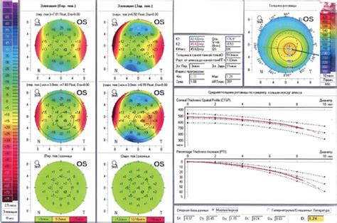 Corneal Image Anterior And Posterior Surface Pachymetry Map Of Download Scientific Diagram