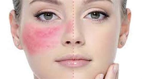 Piel Gruesa Roja Y Con Granos Qué Es La Rosácea Y Cómo Combatirla