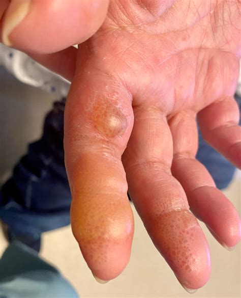 Dermatologic Look Alikes Palmar Blisters Clinical Advisor
