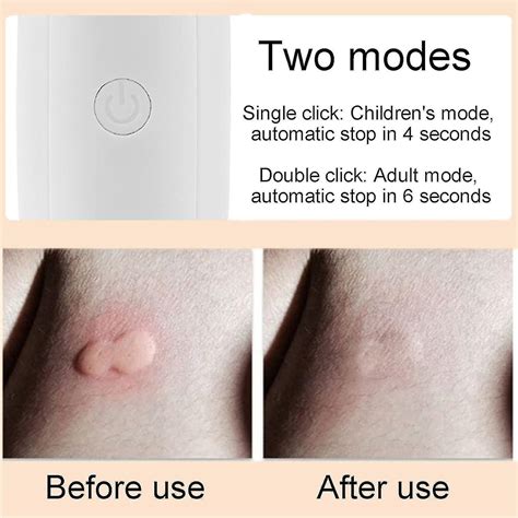 Electric Insect Bite Healer Insect Bite Healer For Mosquito Stings And