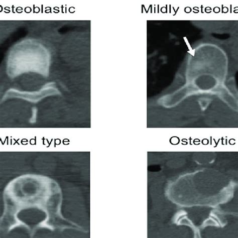 Typical Examples Of Four Types Of Bone Metastasis The Arrow Indicates Download Scientific