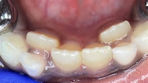 Double Row Of Teeth — Primary Pearls