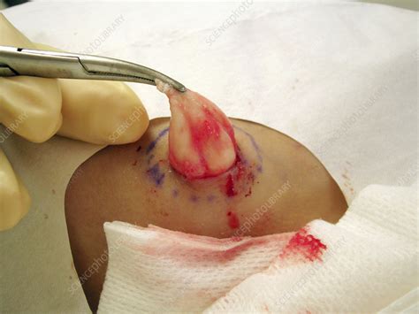Cyst Removal Stock Image C0612618 Science Photo Library