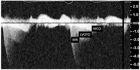Diagnosis And Treatment Of Obstructive Hypertrophic Cardiomyopathy