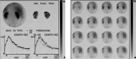 Exercise Renography Renogram And Sequential Images Bilateral Normal