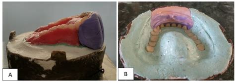 A And B Elastomer Icimpression Material Putty Consistancy Was Placed