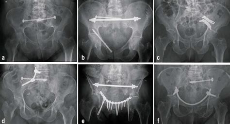 Osteoporotic Pelvic Fractures Pmc