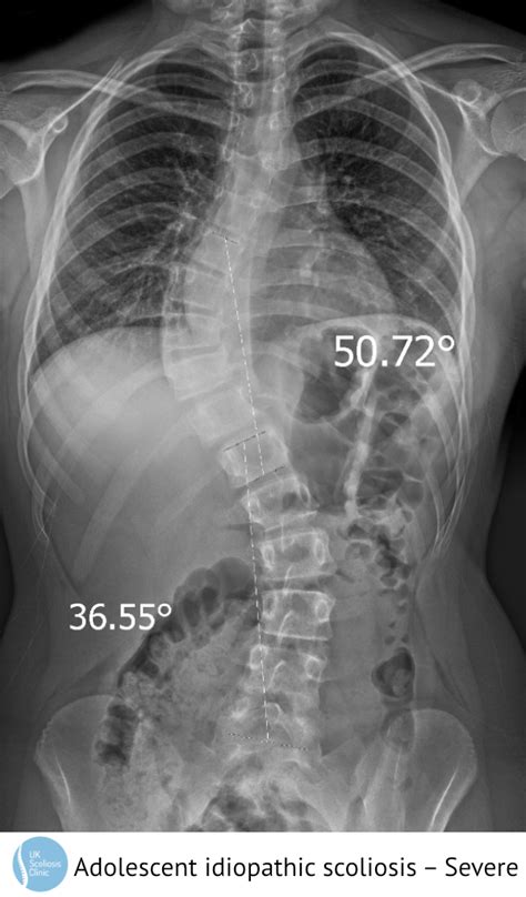 Scoliosis Awareness Month Special Event For Schools Scoliosis