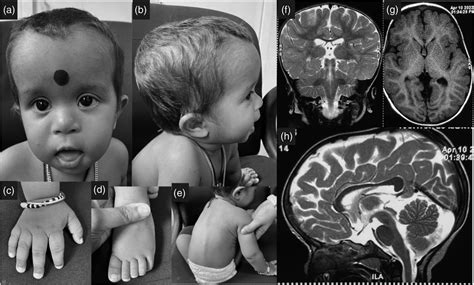 Clinical Dysmorphology