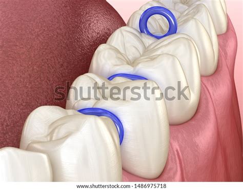 Rubber Separator Between Teeth Preparation Braces Ilustración De Stock