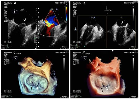 3d Tee At 1 Year Follow Up A Mitral Anterior Leaflet Prolapse White Download Scientific
