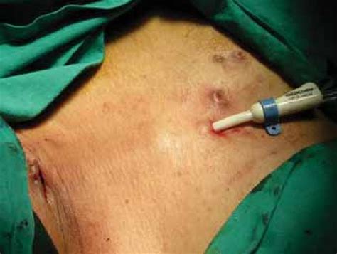 The Final Appearance Of The New Exit Site It Was Slightly More Download Scientific Diagram