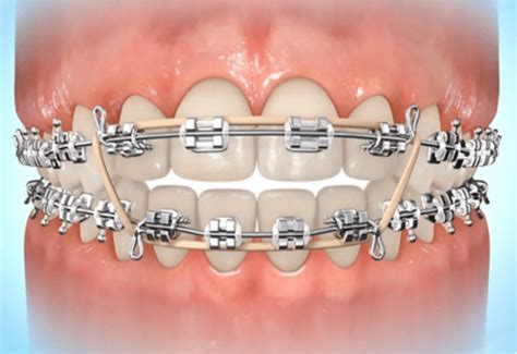 Braces With Elastic Bands Amazing Smiles