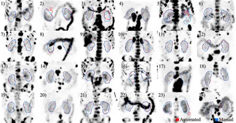 Estimated Radiation Absorbed Dose Applying Either Manual Black Or Download Scientific