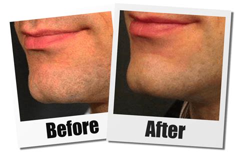 Chin Augmentation Bellevue And Kirkland Chin Reduction Surgery And Cost