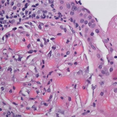 Hematoxylin And Eosin Stain ×40 Shows Normal Glomerulus In Size And Download Scientific
