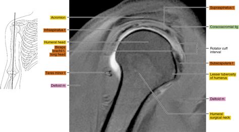 Mr Arthrography Of The Shoulder Radiology Key