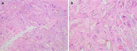 Aetiology And Pathogenesis Of Pulp Disease Basicmedical Key