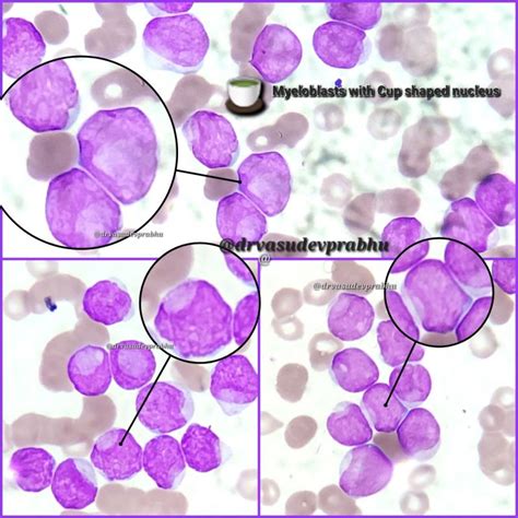 Vasudev Prabhu On Linkedin Hematology Hemepath Pathology