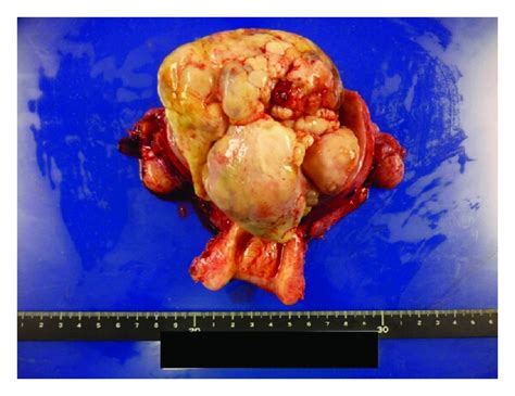 A Case Of Adenosarcoma Of The Uterus Taga 2014 Case Reports In