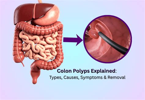 Cause Of Polyps In Colon