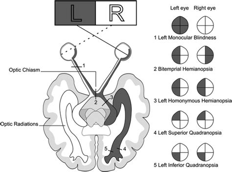 Deficits In Visuospatial Visuoconstructional Skills And Motor Praxis