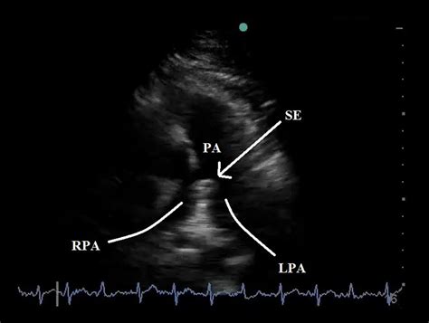 Expanding Our Focus The Utility Of Advanced Echocardiography In The