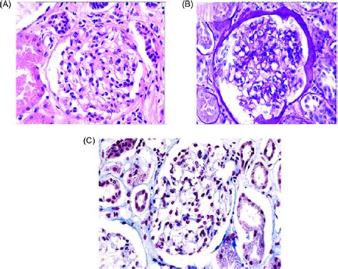 Renal Cortex Biopsy With A Total Of 15 Glomeruli A Hematoxylin And
