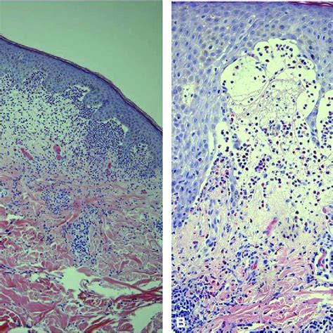 Direct Immunofluorescence Of Perilesional Biopsy Showing Linear Iga Download Scientific Diagram