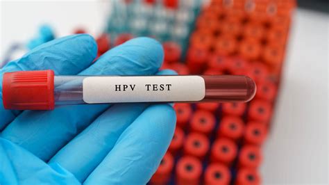 New Ways To Track Hpv Positive Head Neck Cancer Recurrence Clinical