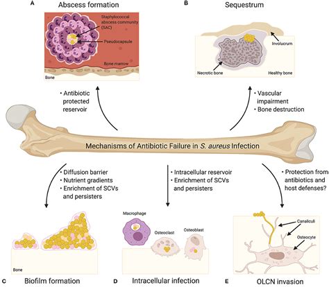 Most Common Cause Of Osteomyelitis