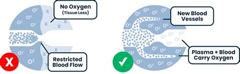 Hyperbaric Oxygen Therapy In Sc Hyper Healing Medical Clinics