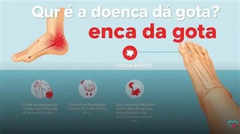 O Que é A Doença Da Gota E Como Ela Afeta Sua Saúde
