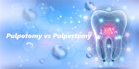 Pulpotomy Vs Pulpectomy