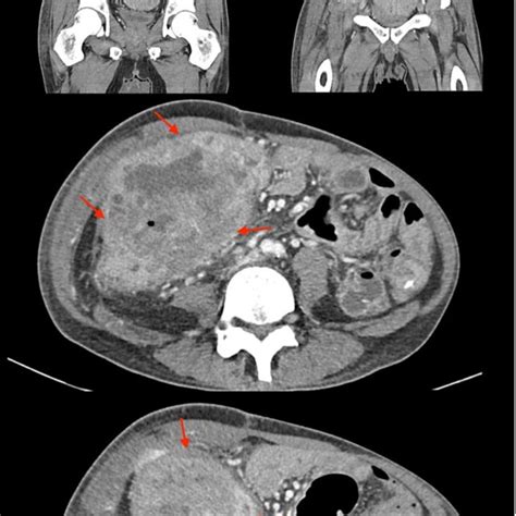 Computerized Tomography Scan Of Male Patient Showing A Large Complex