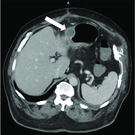 Ct Of Gastric Intramural Abscess Axial View Of Ct Demonstrating A Download Scientific Diagram