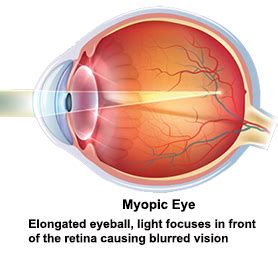 What Is Myopia How Does Myopia Progress Why Is Myopia Control