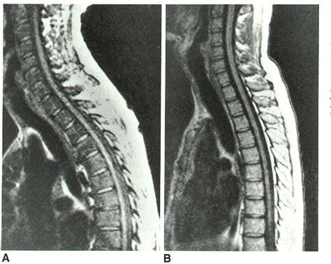 Figure 1 From Abnormal Spinal Bone Marrow On T1 Weighted The Bright Intervertebral Disk An