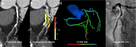 Example Of Combination Ct Ffr With Perivascular Fai For Diagnosis Of